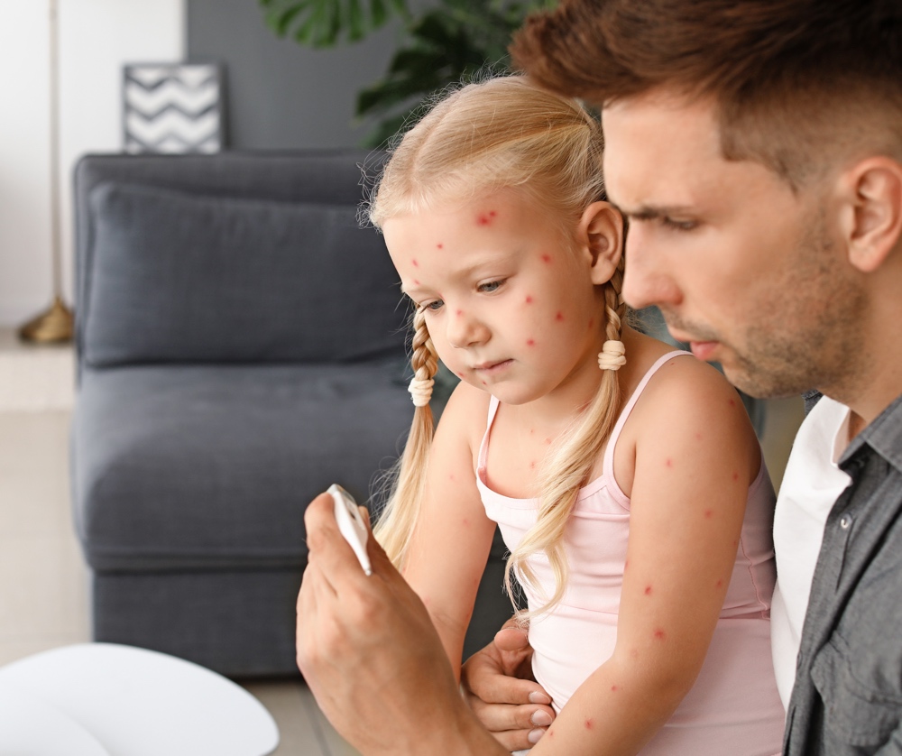Chickenpox Vaccination - Leeds, Bradford, Wakefield and surrounding areas